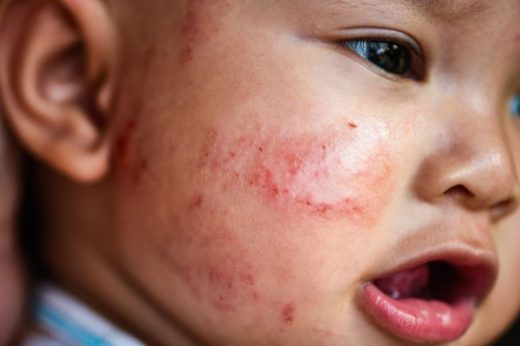 Leading Causes of Baby Dry Skin Rash And Simple Remedies – MamatheFox